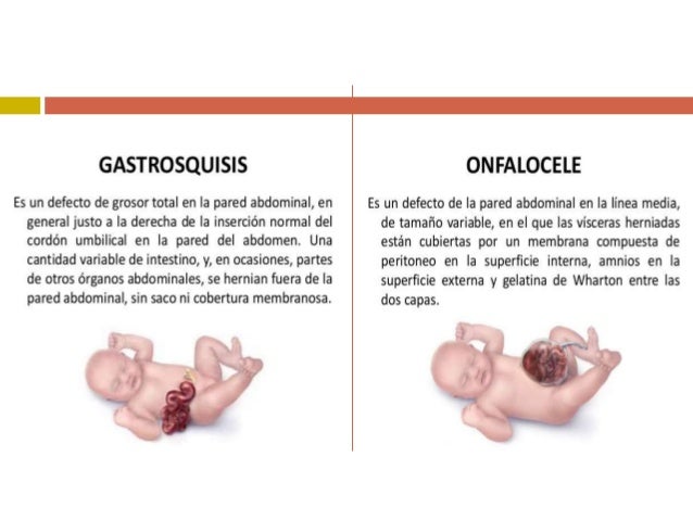 Gastrosquisis y onfalocele