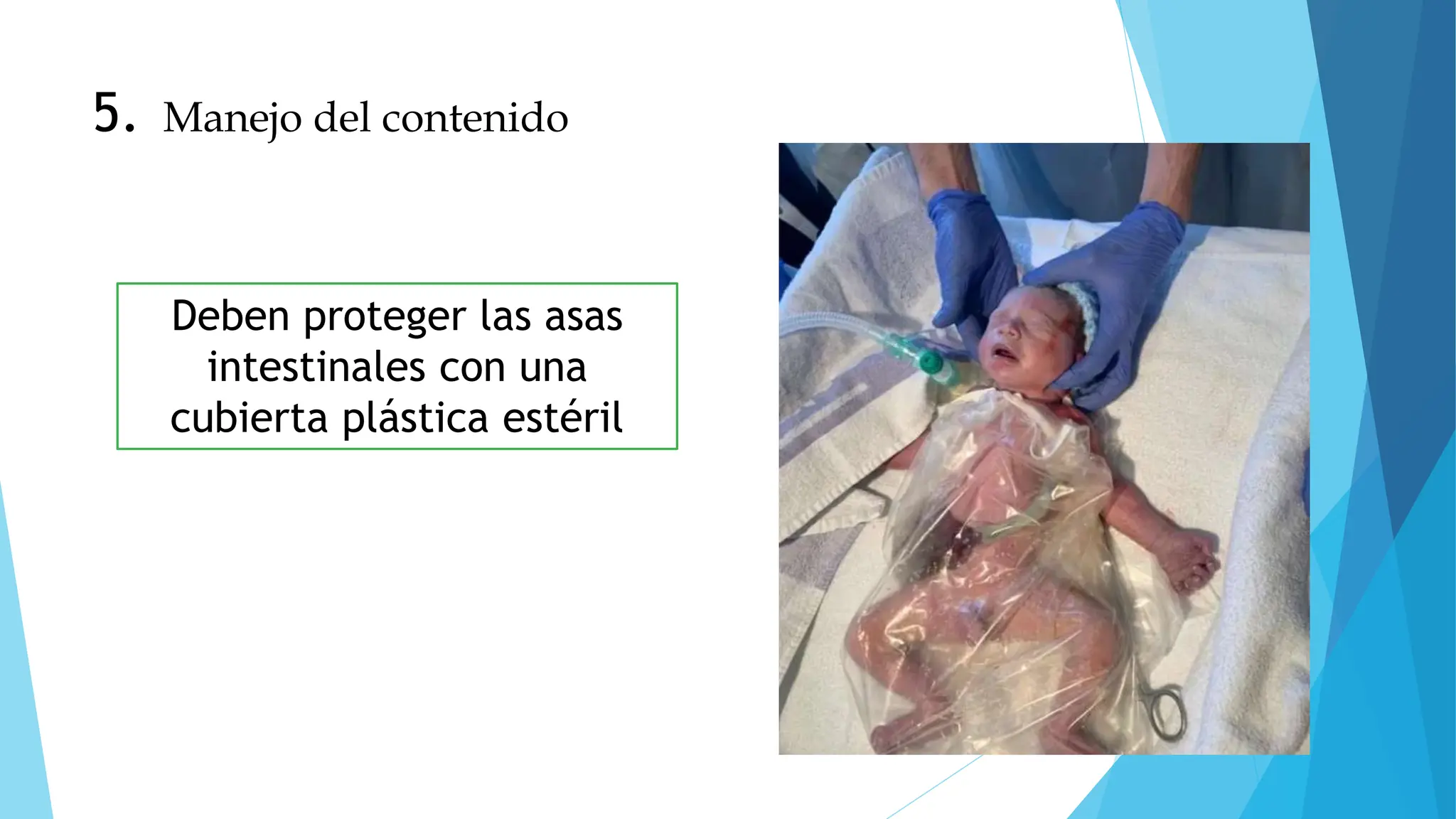 Gastrosquisis y Onfalocele diagnostico y tratamiento | PPTX