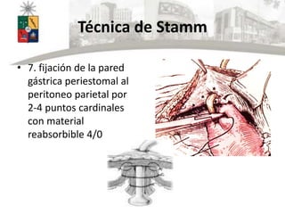 Gastrostomías y yeyunostomías | PPTX