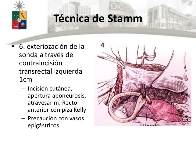 Gastrostomías y yeyunostomías