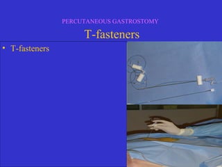 Gastrostomiepercutaneesousscopie | PPT