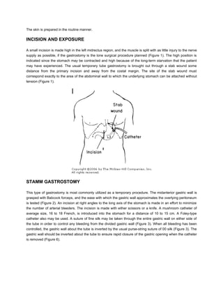 Gastrostomy | DOC