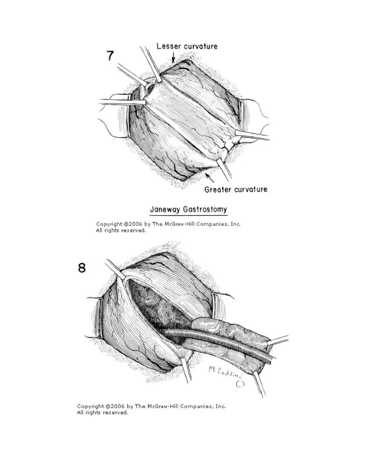 Stamm Gastrostomy