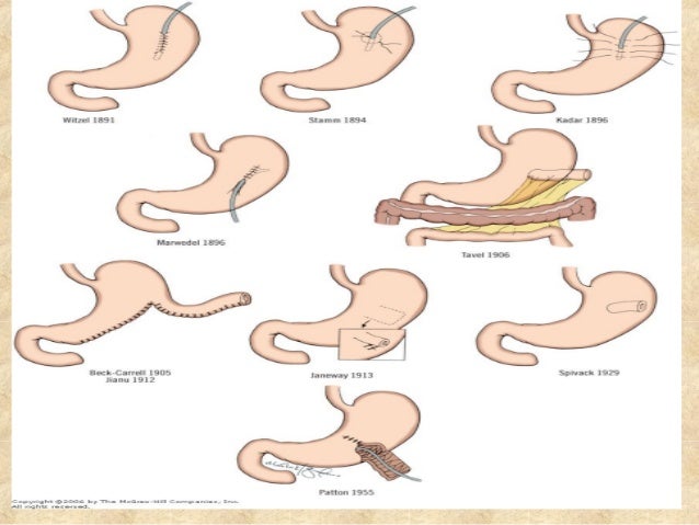 Gastrostomy