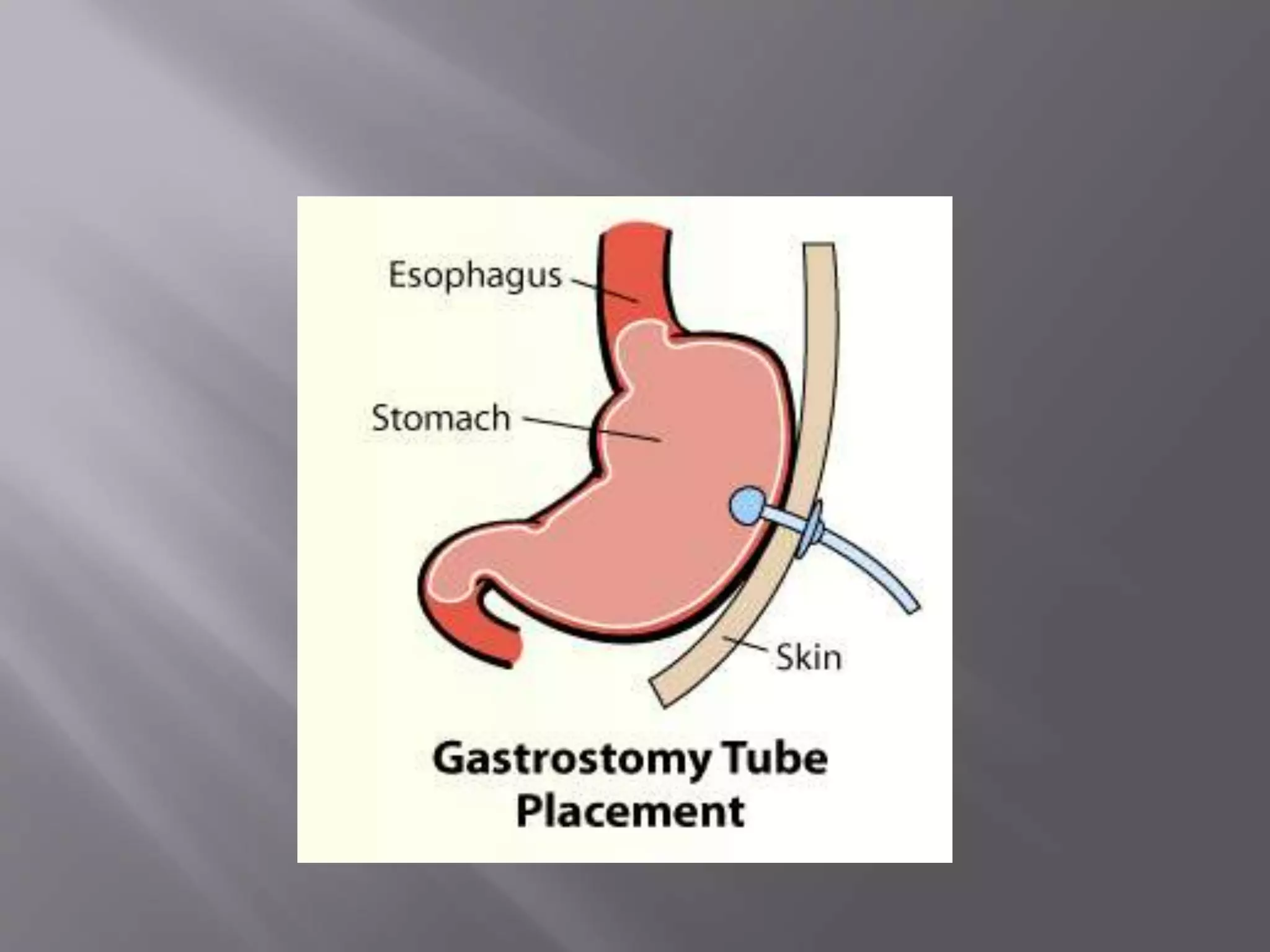 Gastrostomy feeding.pptx