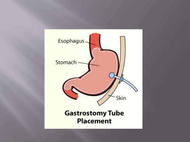 Gastrostomy feeding.pptx | Digestive Disorders | Diseases and Conditions