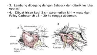 gastrostomy pada tumor esofagus dan tata laksana optek | PPTX