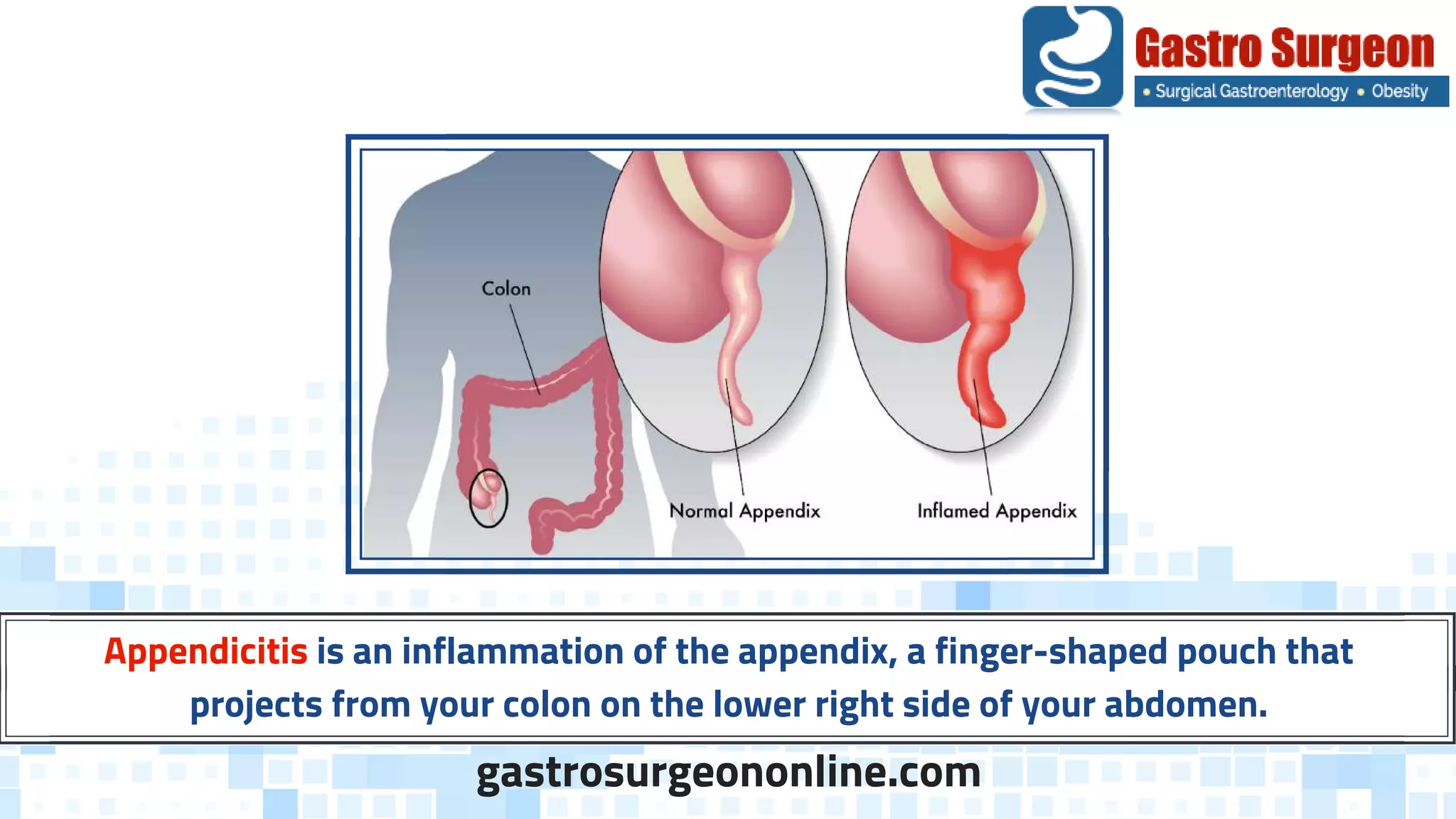 Appendicitis Treatment Chennai | Appendicitis Symptoms | Appendix ...