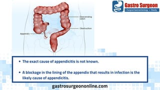 Appendicitis Treatment Chennai | Appendicitis Symptoms | Appendix ...