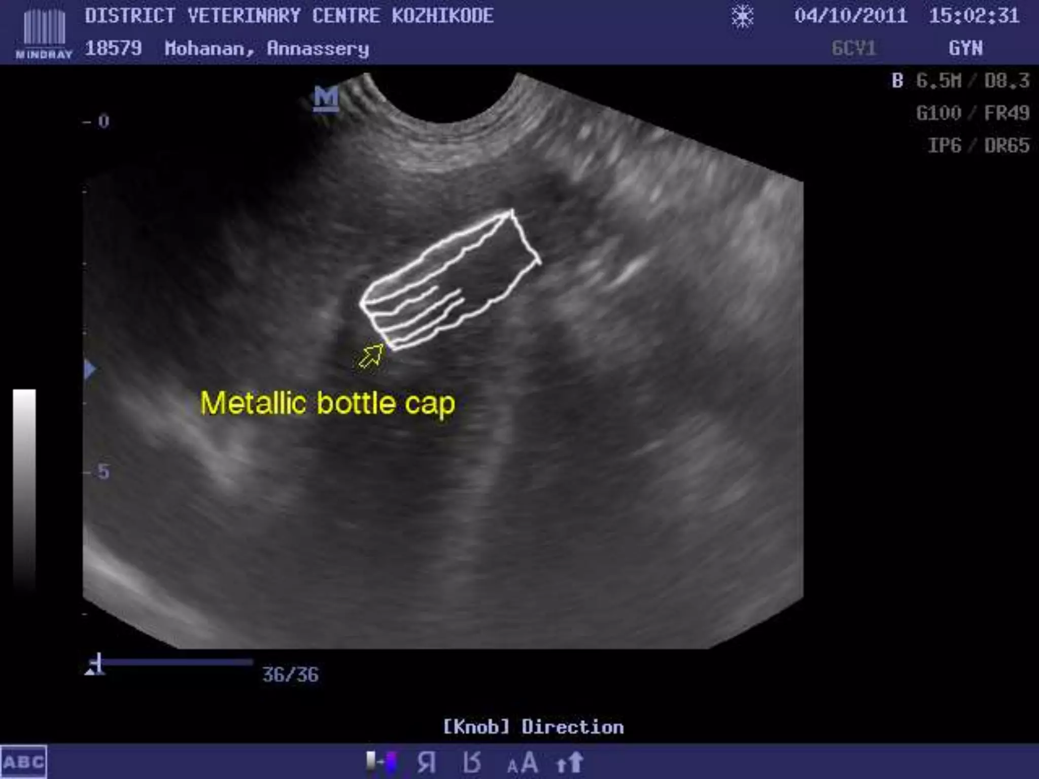 Surgical Extraction of Gastric Foreign Body | PPT