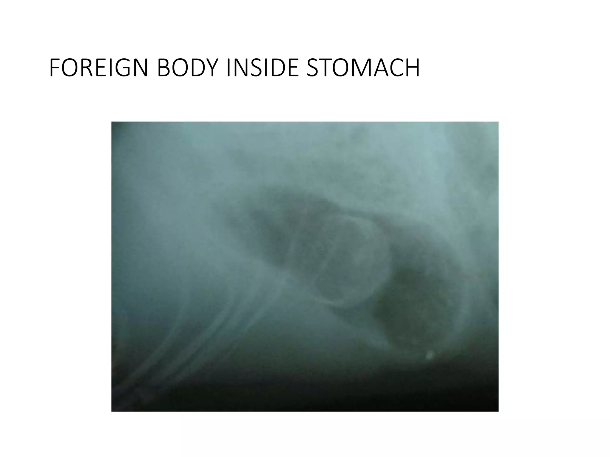 Surgical Extraction of Gastric Foreign Body | PPT