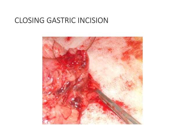 Surgical Extraction of Gastric Foreign Body | PPT