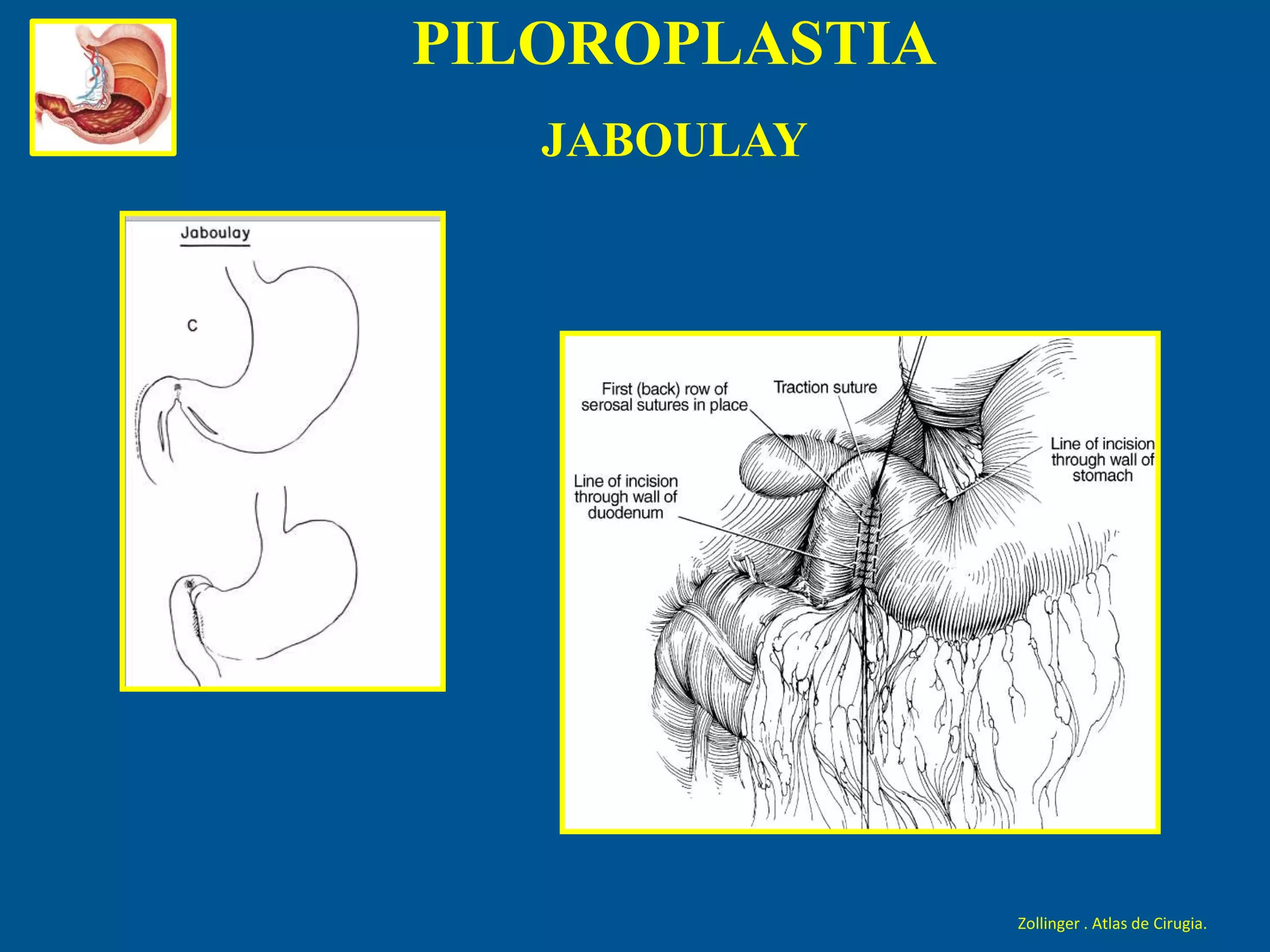 Gastroyeyunostomia, piloroplastia