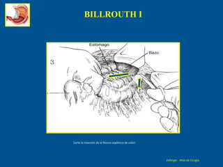 Gastroyeyunostomia, piloroplastia | PPTX