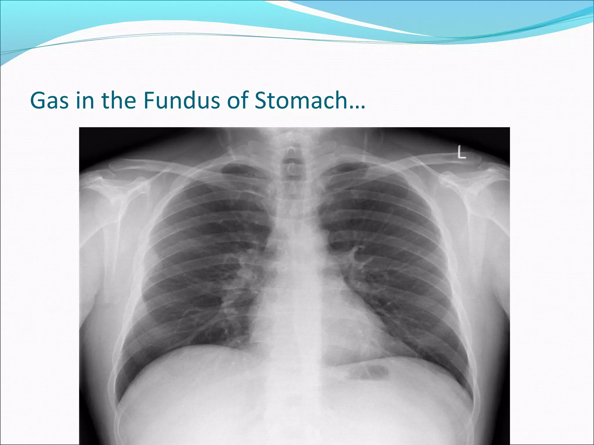 Gas Under Diaphragm - Final Year MB BS Lecture | PPT