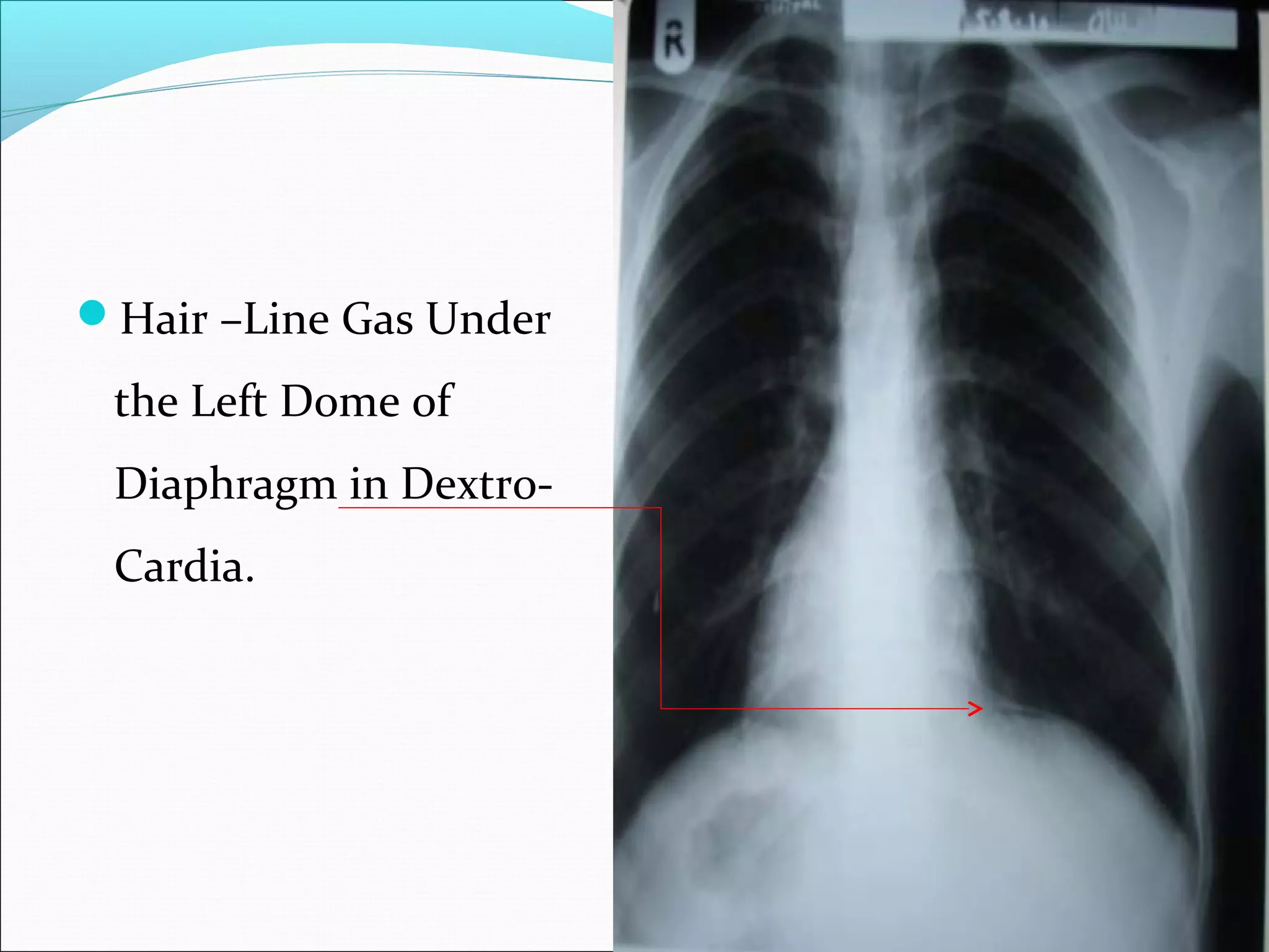 Gas Under Diaphragm - Final Year MB BS Lecture | PPT