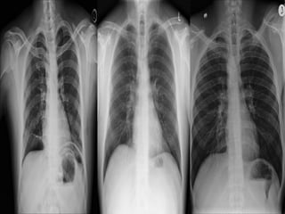 Gas Under Diaphragm - Final Year MB BS Lecture | PPT