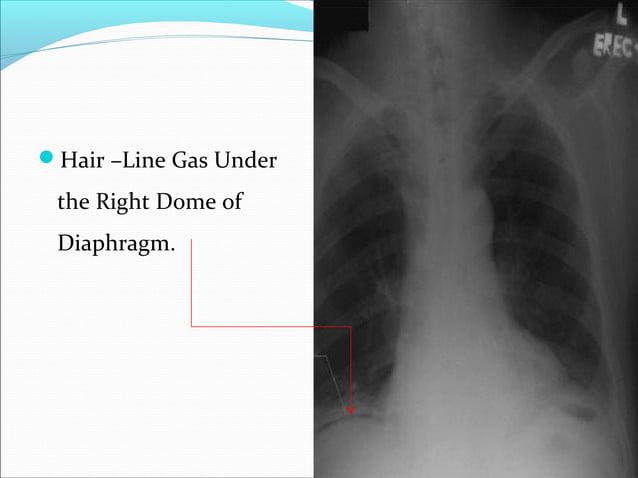 Gas Under Diaphragm - Final Year MB BS Lecture | PPT