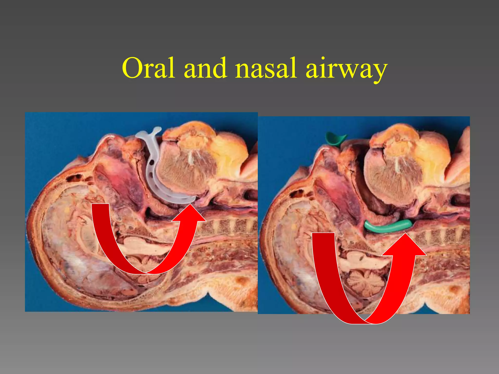 GENERAL ANESTHESIA TECHNIQUE.ppt