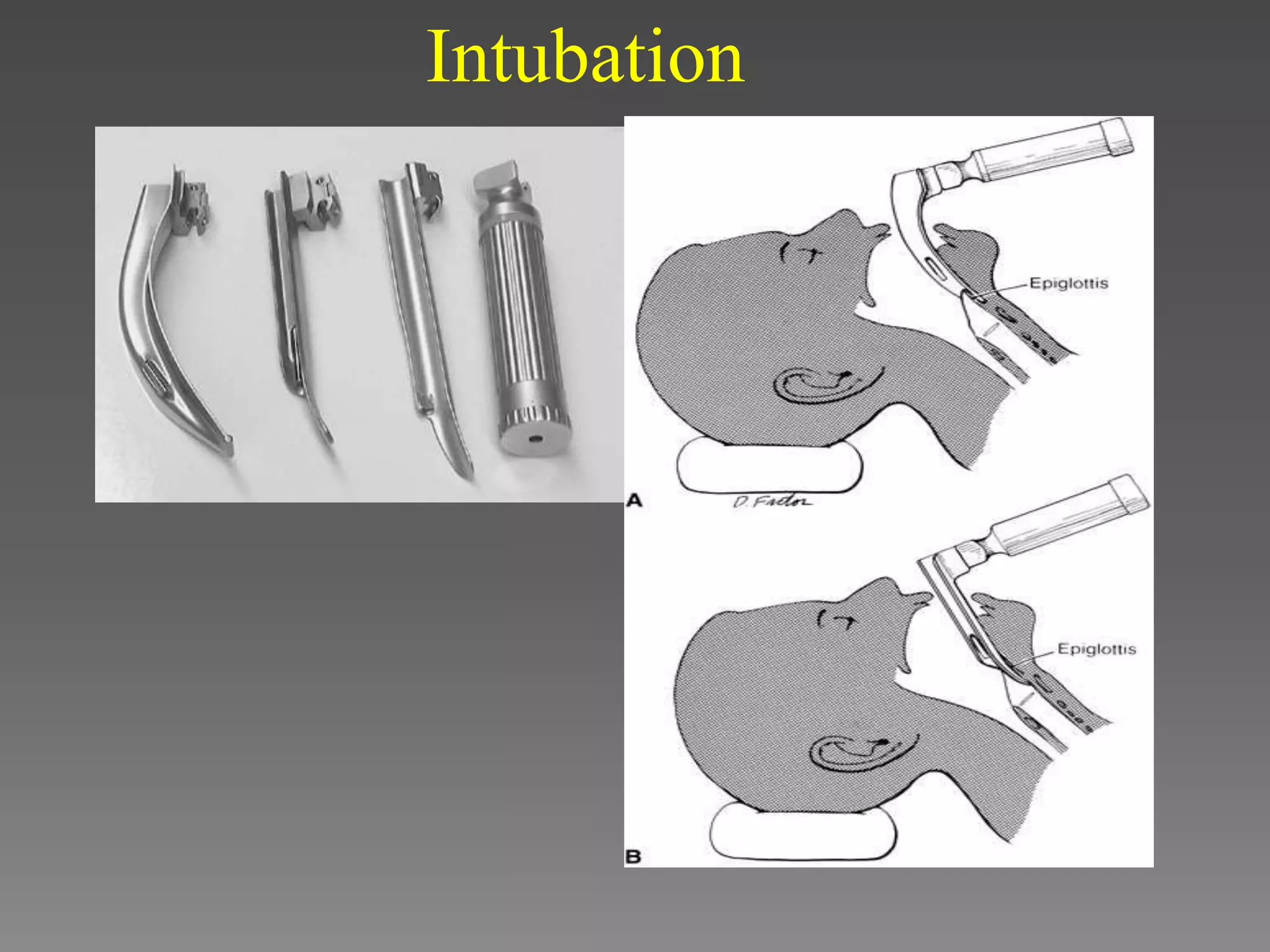 GENERAL ANESTHESIA TECHNIQUE.ppt