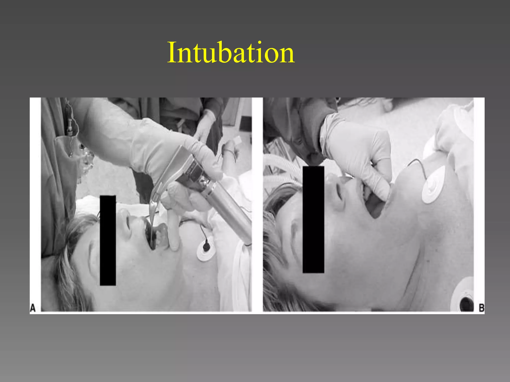 GENERAL ANESTHESIA TECHNIQUE.ppt