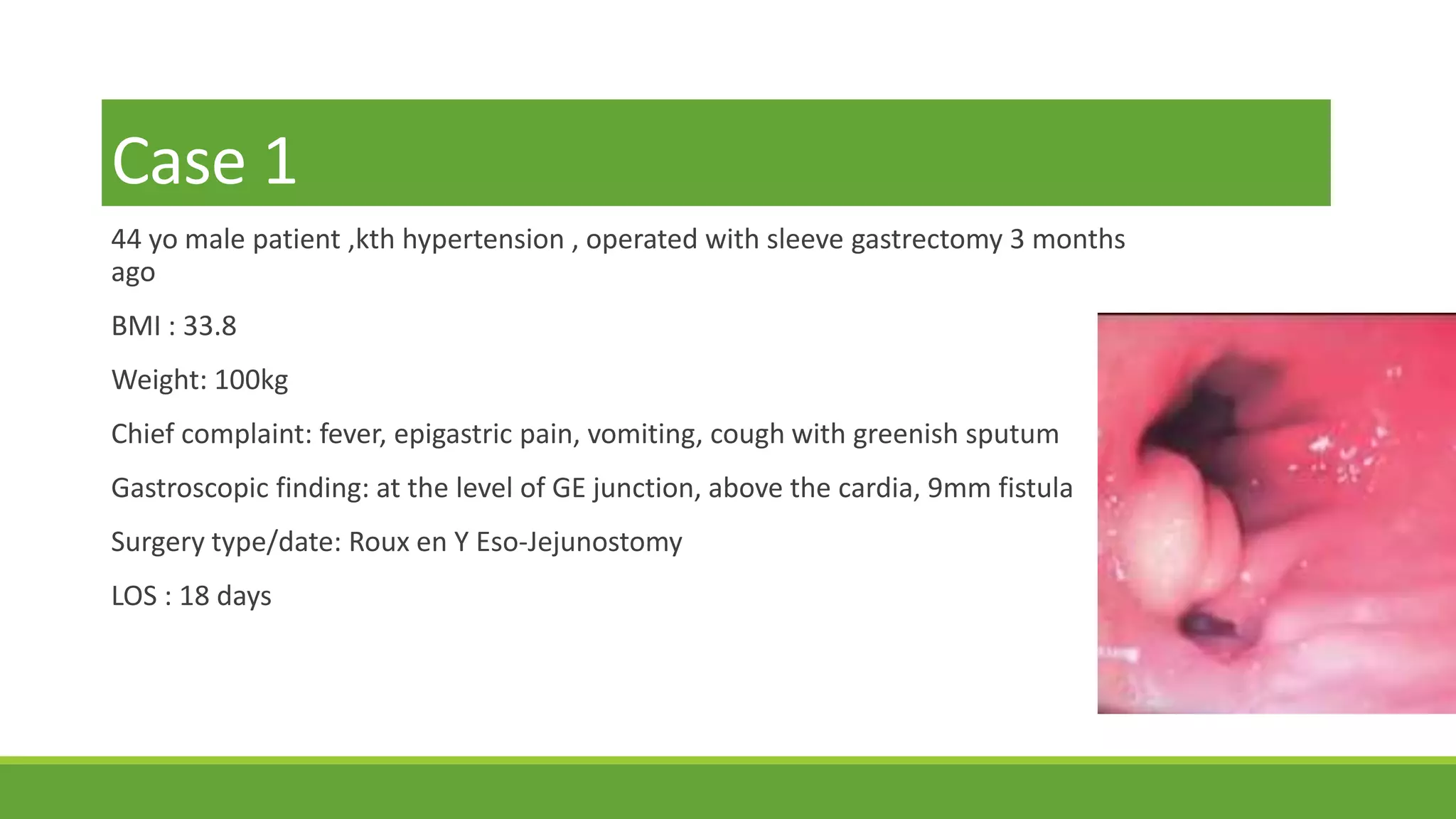 Gastro-Bronchial Fistula post Sleeve Gastrectomy | PPT