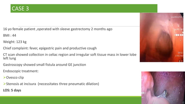 Gastro-Bronchial Fistula post Sleeve Gastrectomy | PPT