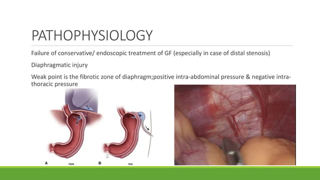 Gastro-Bronchial Fistula post Sleeve Gastrectomy | PPT