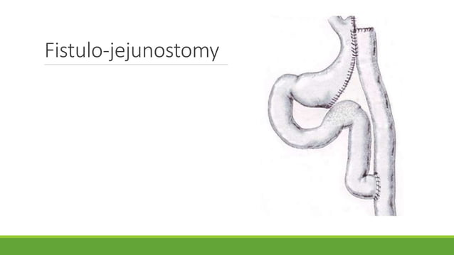 Gastro-Bronchial Fistula post Sleeve Gastrectomy | PPT