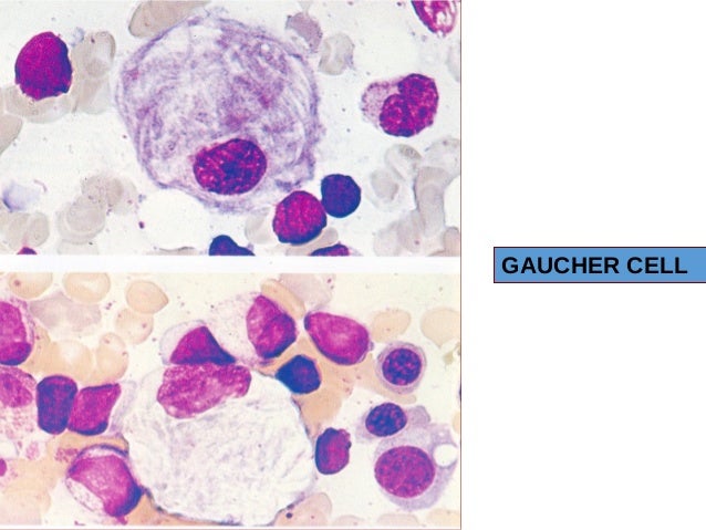 Gaucher's disease - Pathology