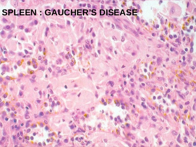 Gaucher's disease - Pathology