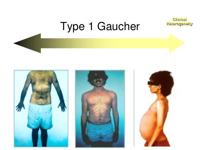 Gaucher disease past present future