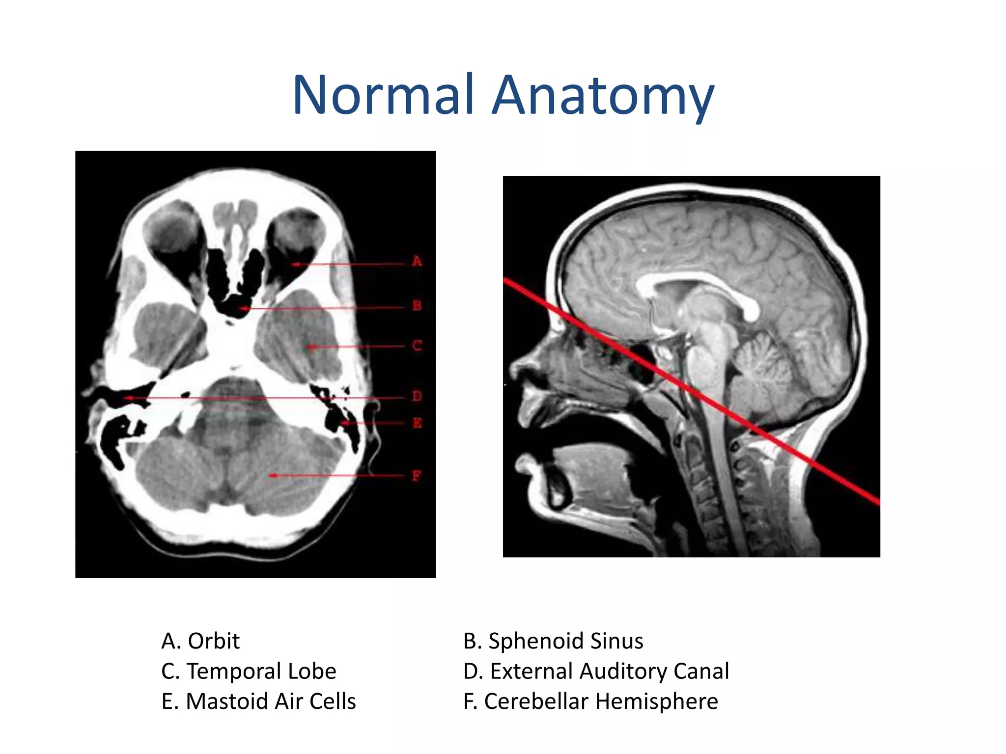 How to read a Head CT, CT Brain | PPTX