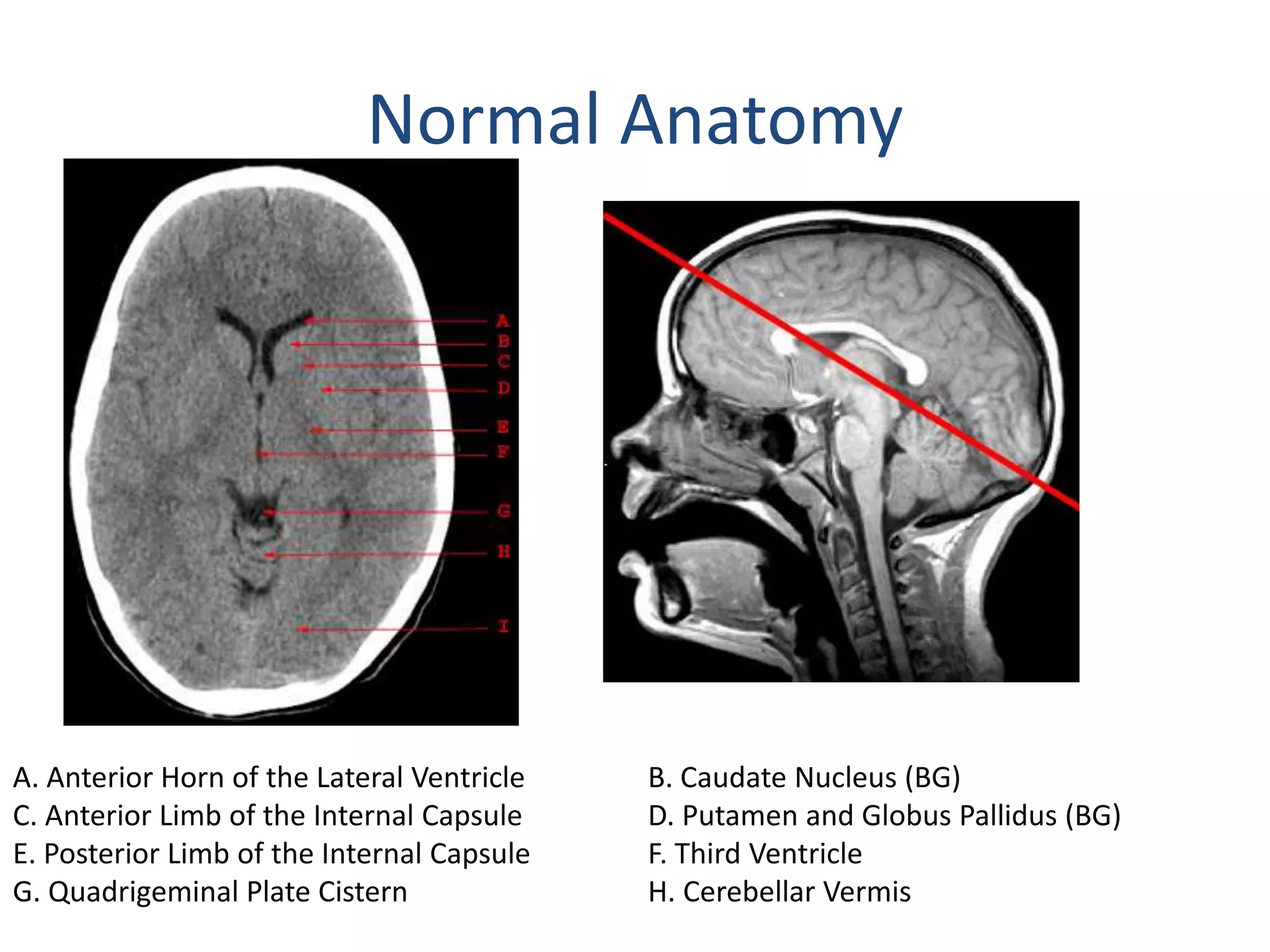 How to read a Head CT, CT Brain | PPTX