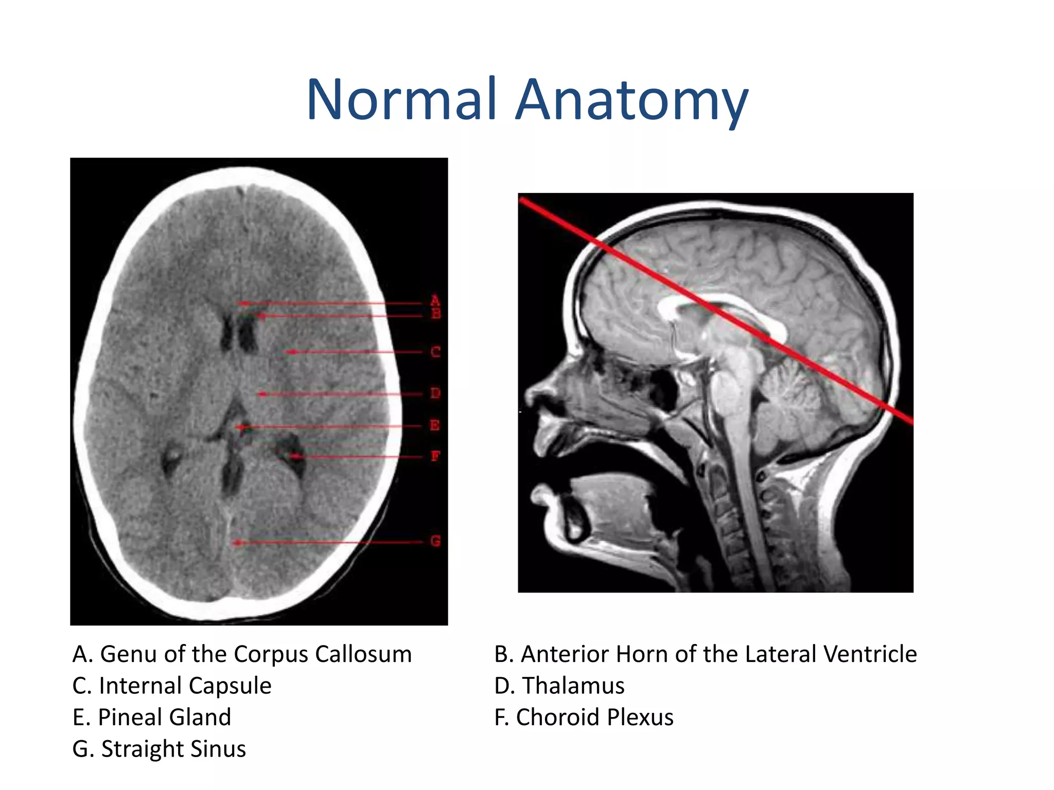 How to read a Head CT, CT Brain | PPTX