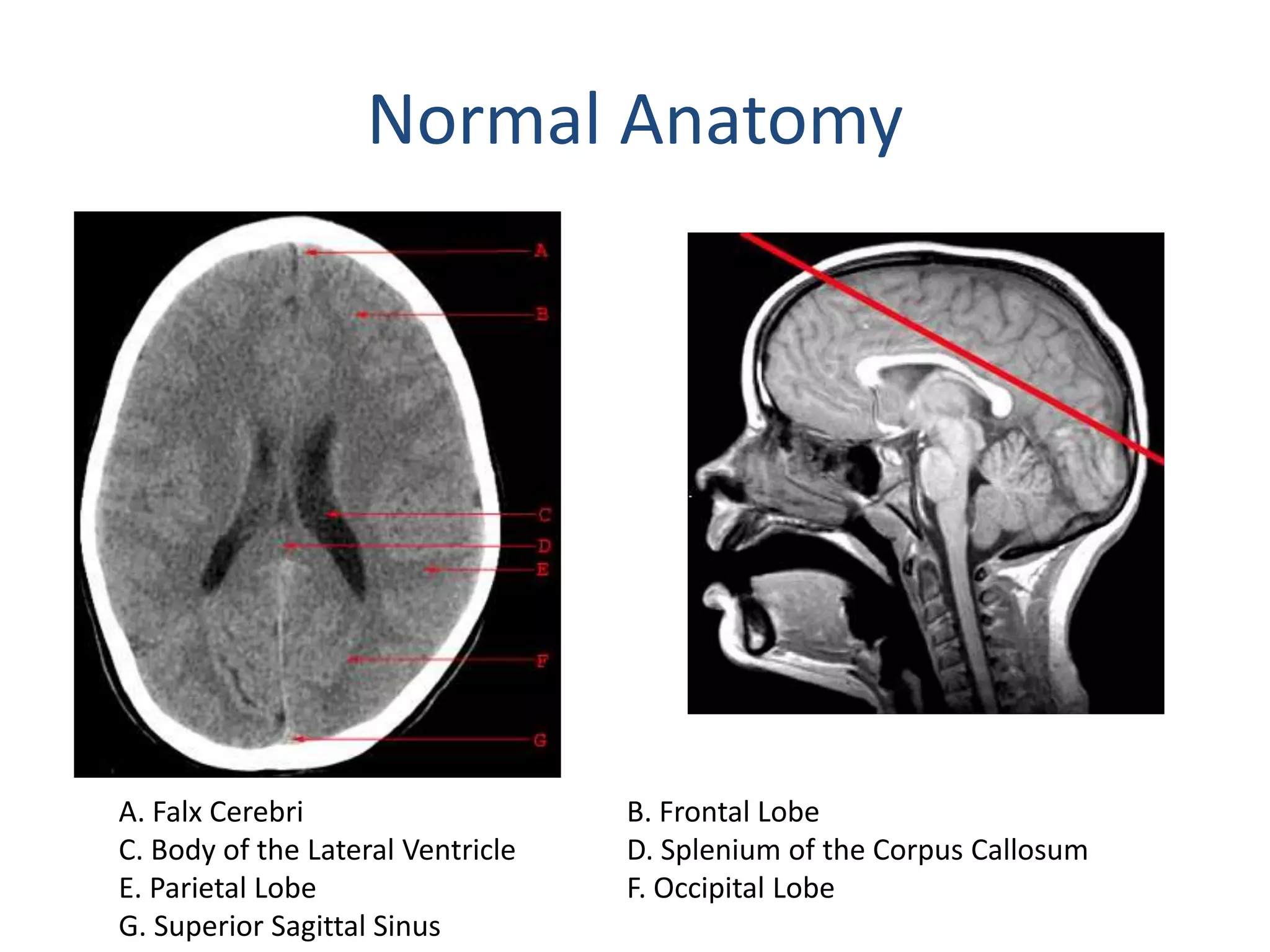 How to read a Head CT, CT Brain | PPTX