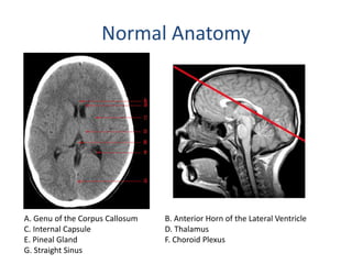 How to read a Head CT, CT Brain | PPTX