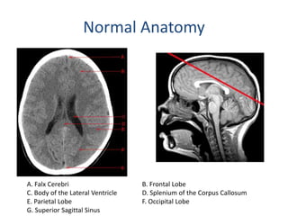 How to read a Head CT, CT Brain | PPTX