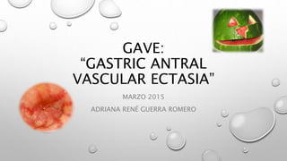 GASTRIC ANTRAL VASCULAR ECTASIA | PPT