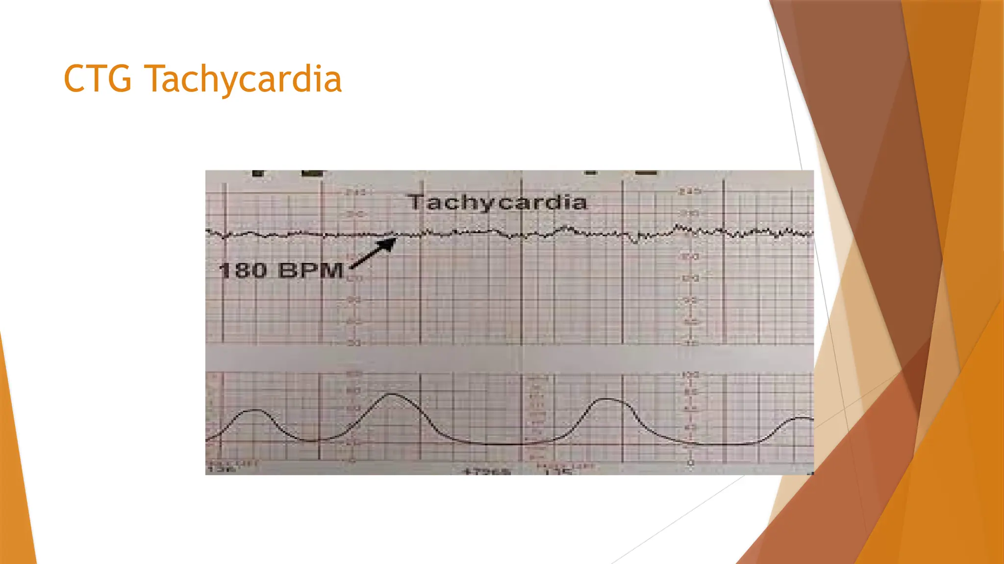 GAWAT JANIN DAN RESUSITASI INTRAUTERINE.pptx