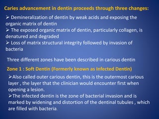 Primary caries secondary caries tertiary caries | PPTX