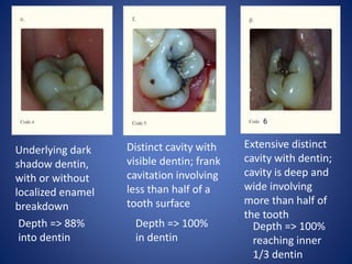 Primary caries secondary caries tertiary caries | PPT