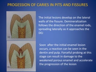 Primary caries secondary caries tertiary caries | PPT