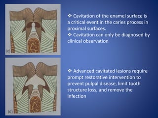 Primary caries secondary caries tertiary caries | PPTX