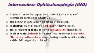 Internuclear Ophthalmoplegia Mechanism