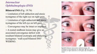 Conjugate Vertical Gaze