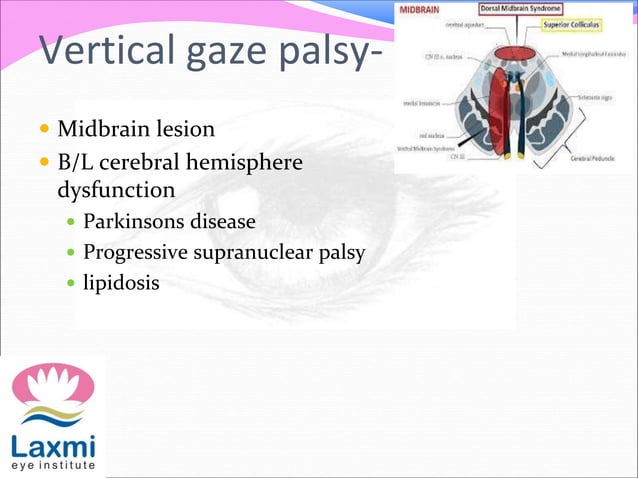 Gaze palsy | PPTX | Eye and Vision Conditions | Diseases and Conditions