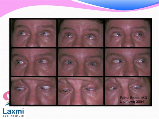 Gaze palsy | PPTX | Eye and Vision Conditions | Diseases and Conditions