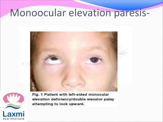 Gaze palsy | PPTX | Eye and Vision Conditions | Diseases and Conditions