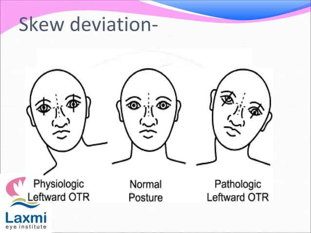 Gaze palsy | PPTX | Eye and Vision Conditions | Diseases and Conditions
